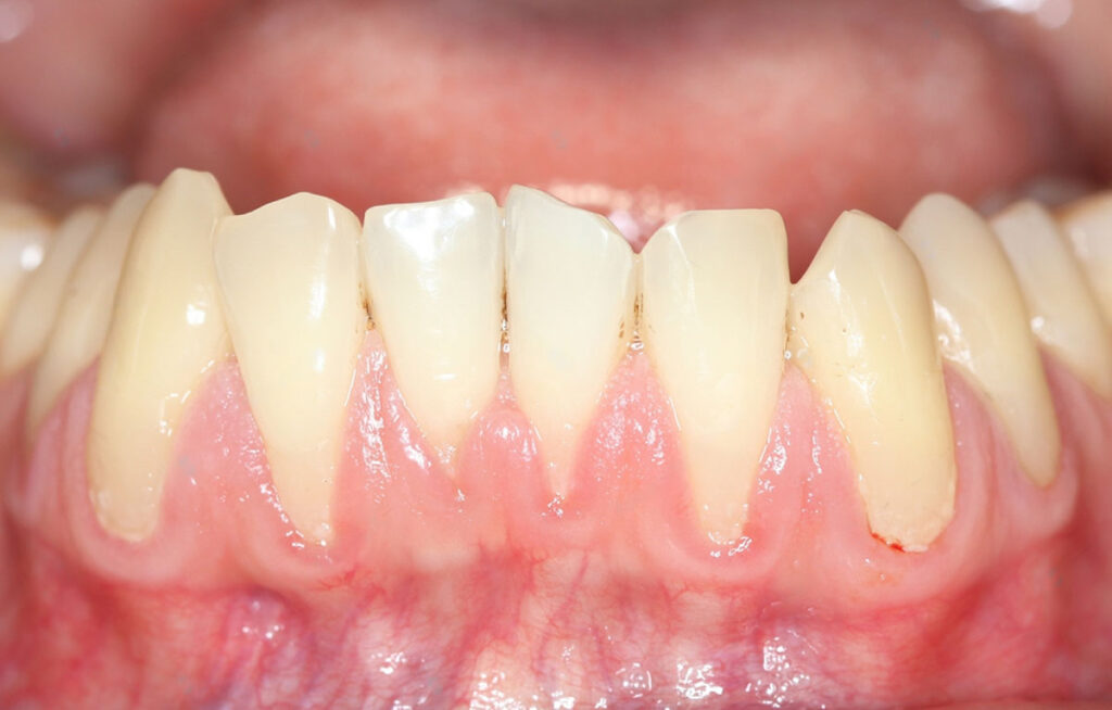 O que é a Recessão (retração) Gengival e como Tratar? O que é a ...